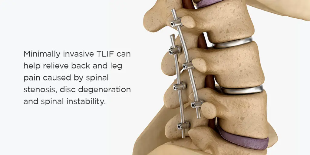 Understanding TLIF Surgery - Mountain Spine & Orthopedics